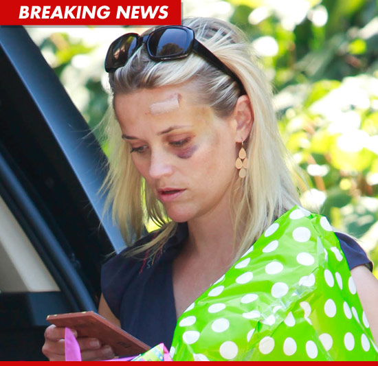 Reese Witherspoon -- Big Black Eye After Car Accident | TMZ.com