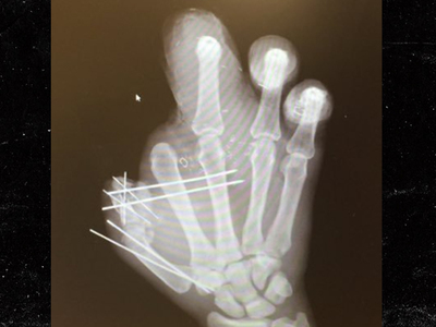 Jason Pierre-Paul Shows Graphic Fireworks Injury Pics | TMZ.com